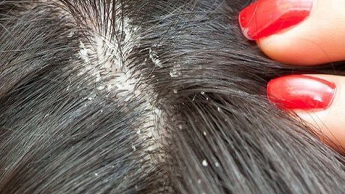 Zeci de elevi de la şcoli din Olt, găsiţi cu păduchi | Gazeta Nouă